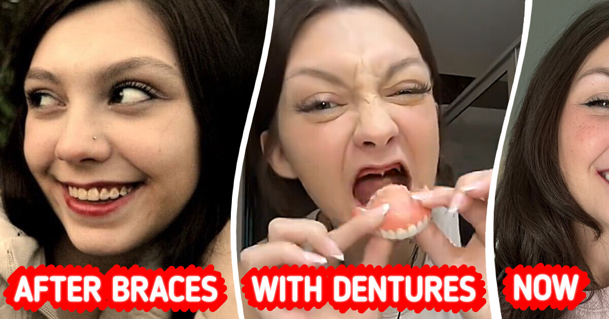 Woman, 32, Who Lost All Teeth at 20, Revealed Her Drastic Dental ...