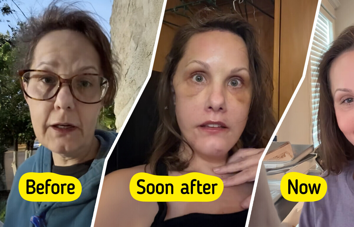 Woman, 50, Reveals Her Dramatic Plastic Surgery Results — and People ...